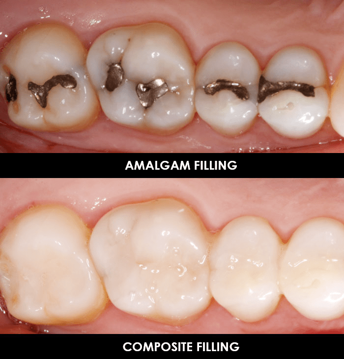 Amalgam or Composite Fillings | Fillings Used in Dentistry